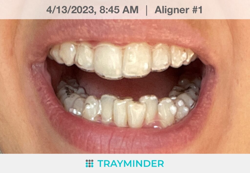 First 24 hours of Invisalign – What to Expect | Invisalign Journey ...